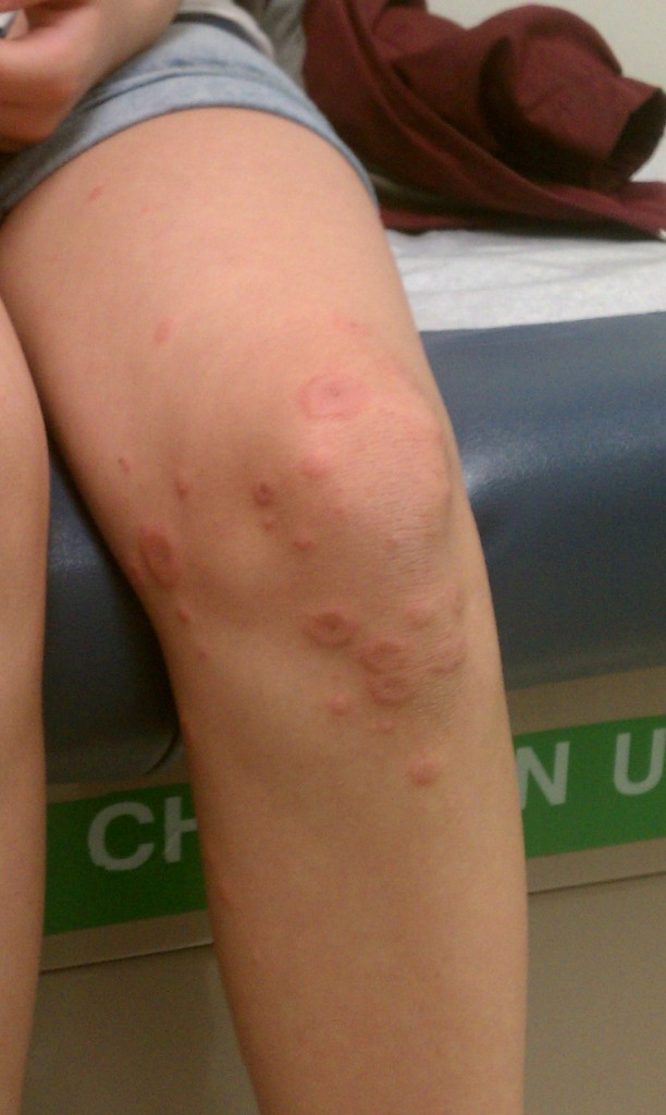 Duck Itch – Coastal CPR and First Aid